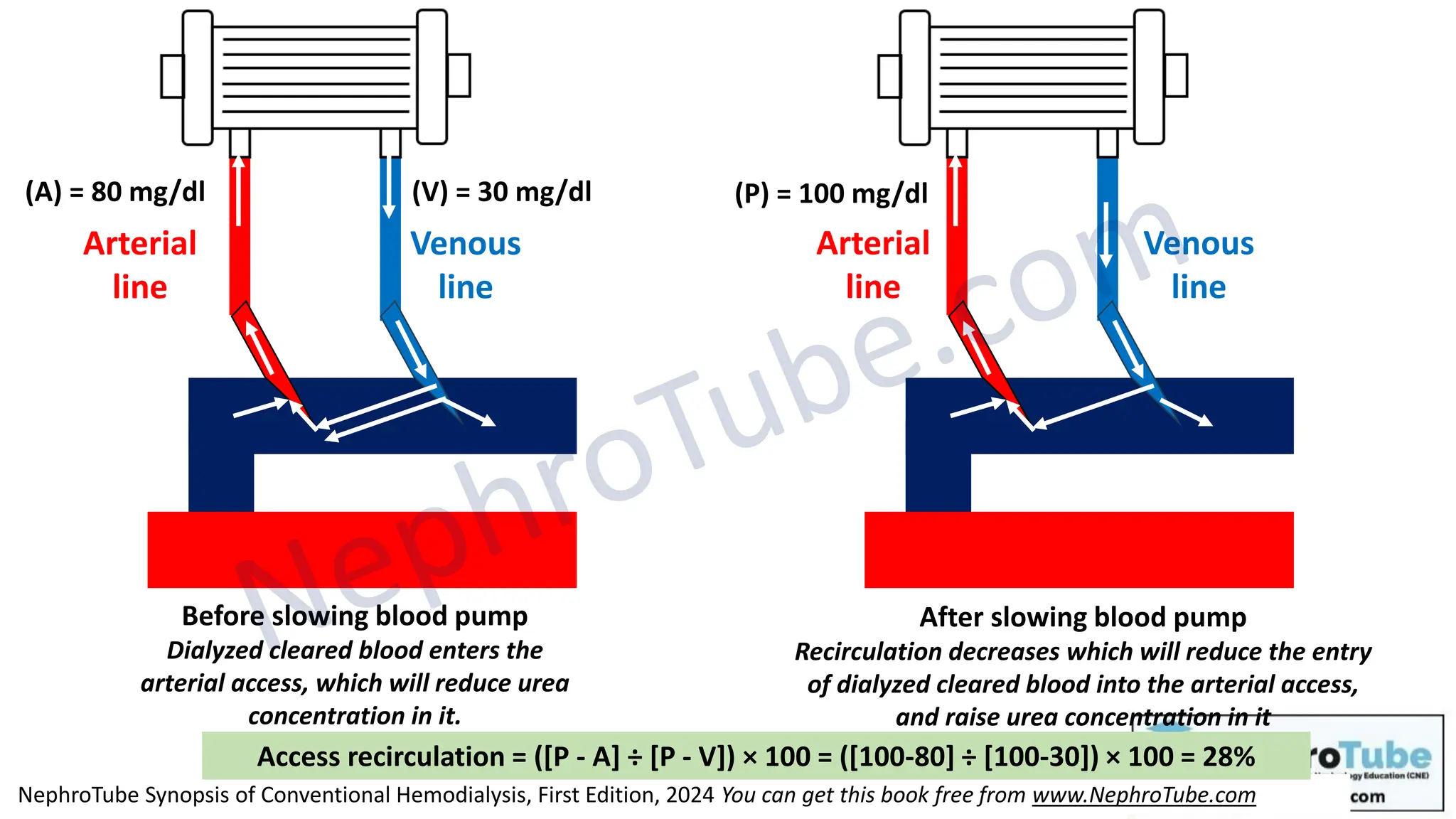 Hemodialysis: Chapter 10, AVF and AVG - Complications (Diagnosis and ...
