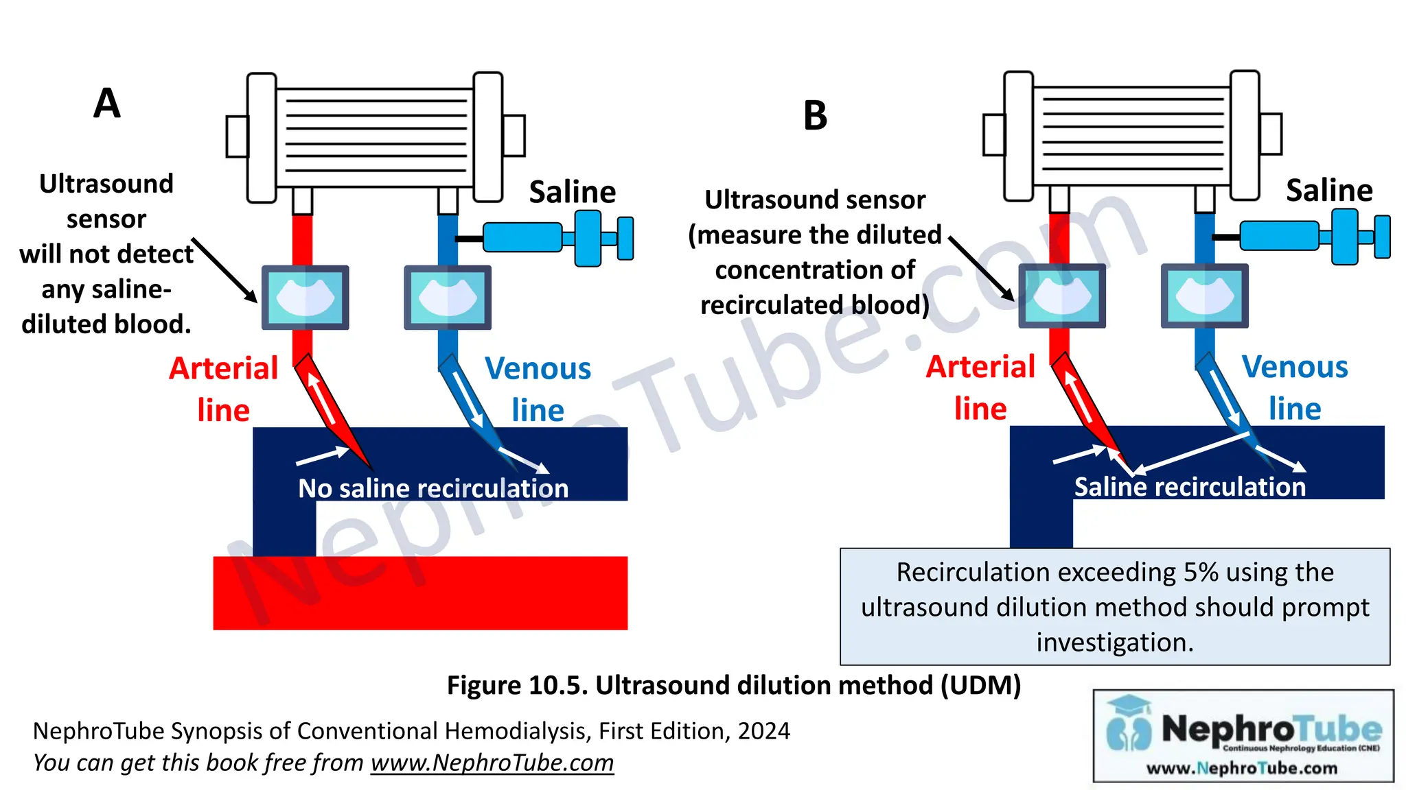 Hemodialysis: Chapter 10, AVF and AVG - Complications (Diagnosis and ...