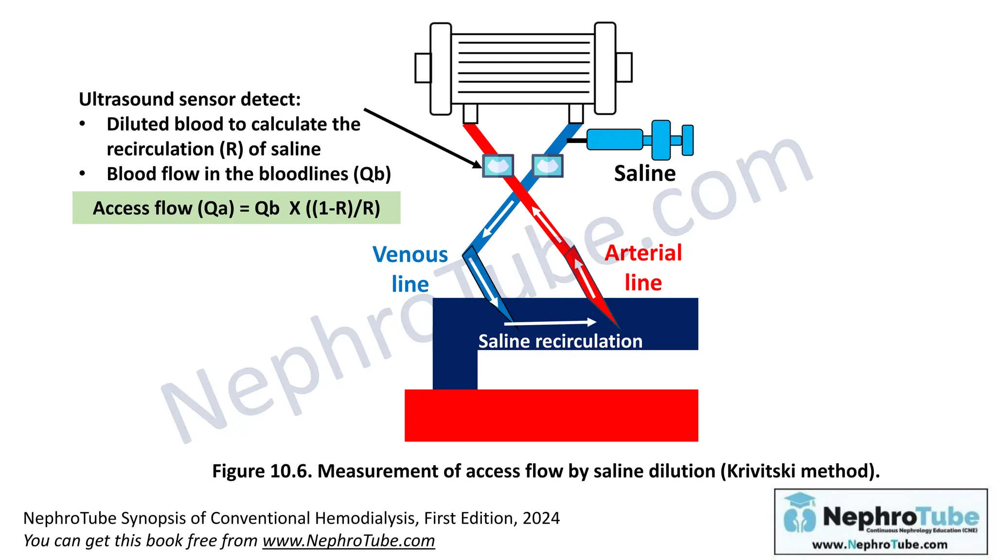 Hemodialysis: Chapter 10, AVF and AVG - Complications (Diagnosis and ...