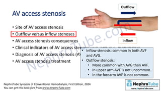Hemodialysis: Chapter 10, AVF and AVG - Complications (Diagnosis and ...