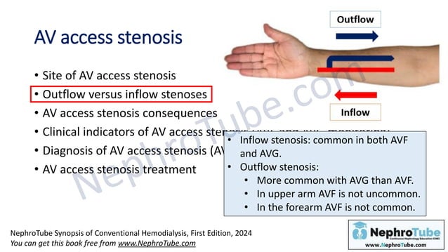 Hemodialysis: Chapter 10, AVF and AVG - Complications (Diagnosis and Management) - Dr.Gawad | PDF