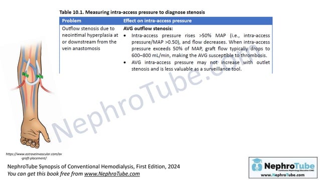 Hemodialysis: Chapter 10, AVF and AVG - Complications (Diagnosis and ...
