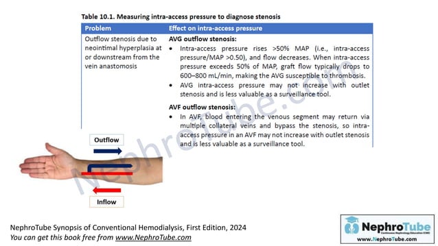 Hemodialysis: Chapter 10, AVF and AVG - Complications (Diagnosis and Management) - Dr.Gawad | PDF