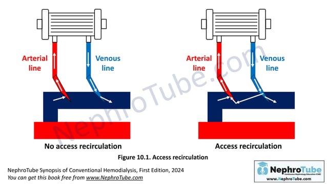 Hemodialysis: Chapter 10, AVF and AVG - Complications (Diagnosis and ...
