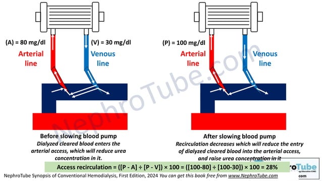 Hemodialysis: Chapter 10, AVF and AVG - Complications (Diagnosis and ...