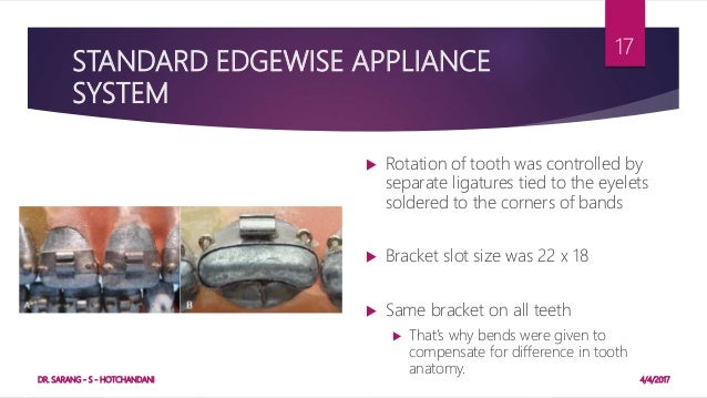 Fixed Orthodontic Appliance (Dentistry) #Braces