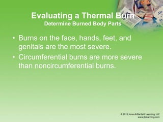 Chapter 11 Burns | PPTX