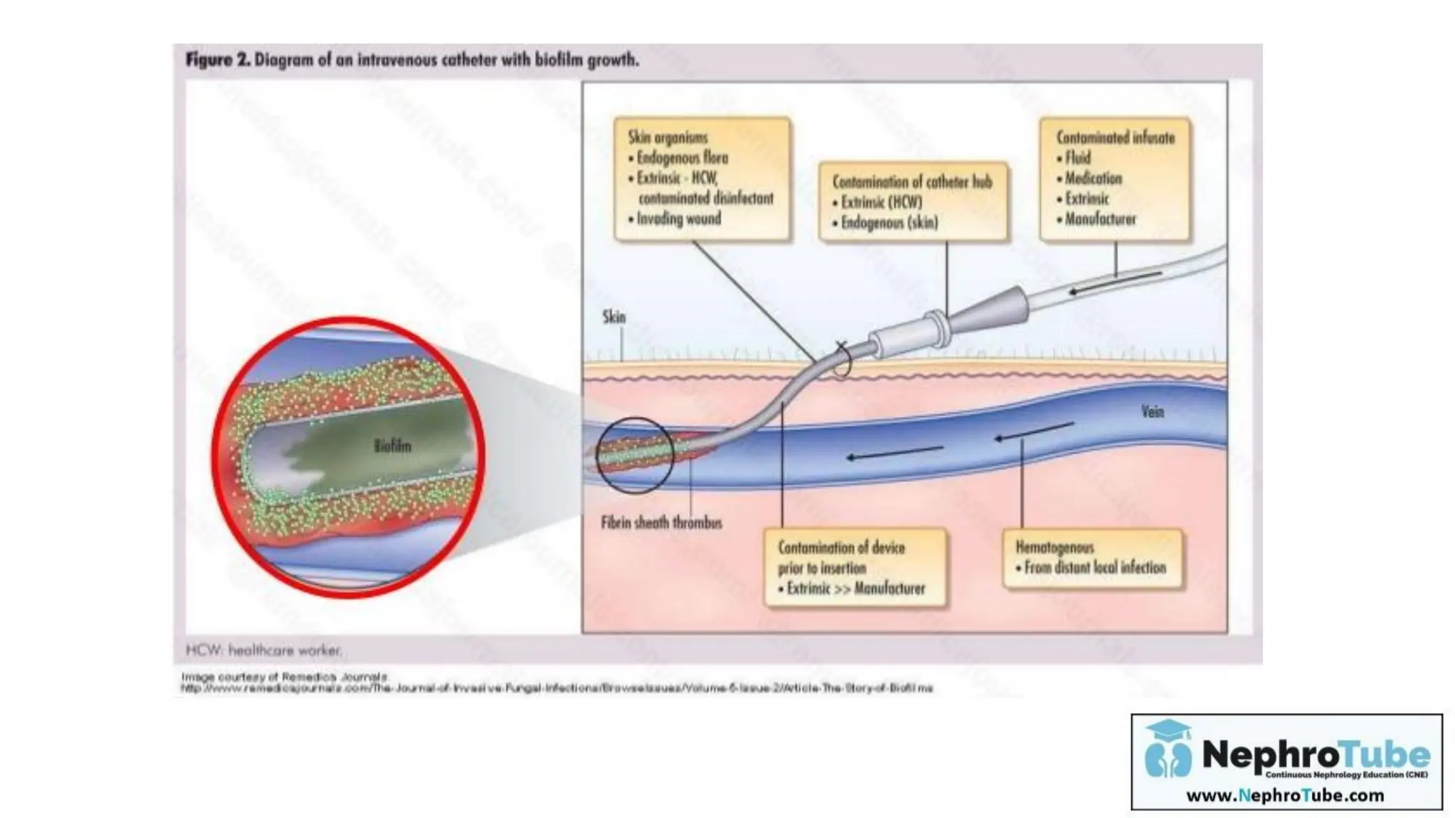 Hemodialysis: Chapter 11, Venous Catheter - Basics, Insertion, Use and ...