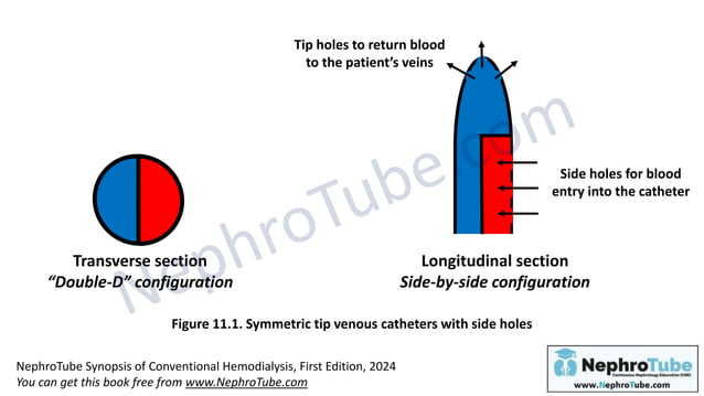 Hemodialysis: Chapter 11, Venous Catheter - Basics, Insertion, Use and ...