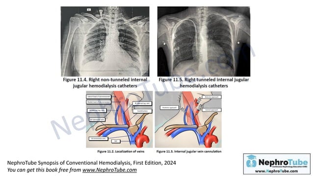 Hemodialysis: Chapter 11, Venous Catheter - Basics, Insertion, Use and Care - Dr.Gawad | PDF