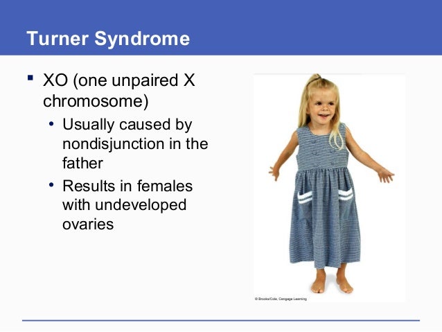Turner Syndrome Xo Chromosome Maeteroch