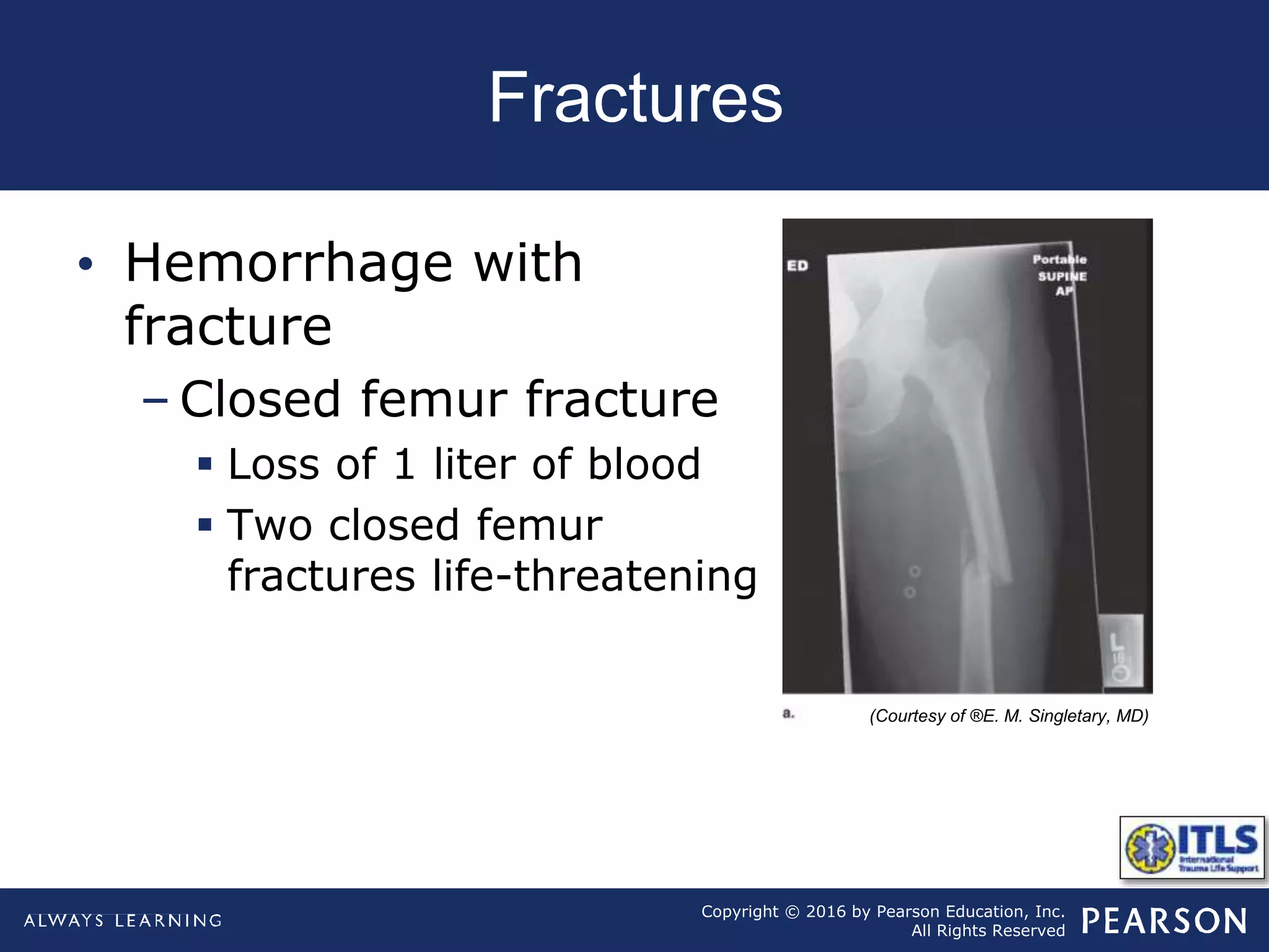 Chapter14 extremity trauma | PPT
