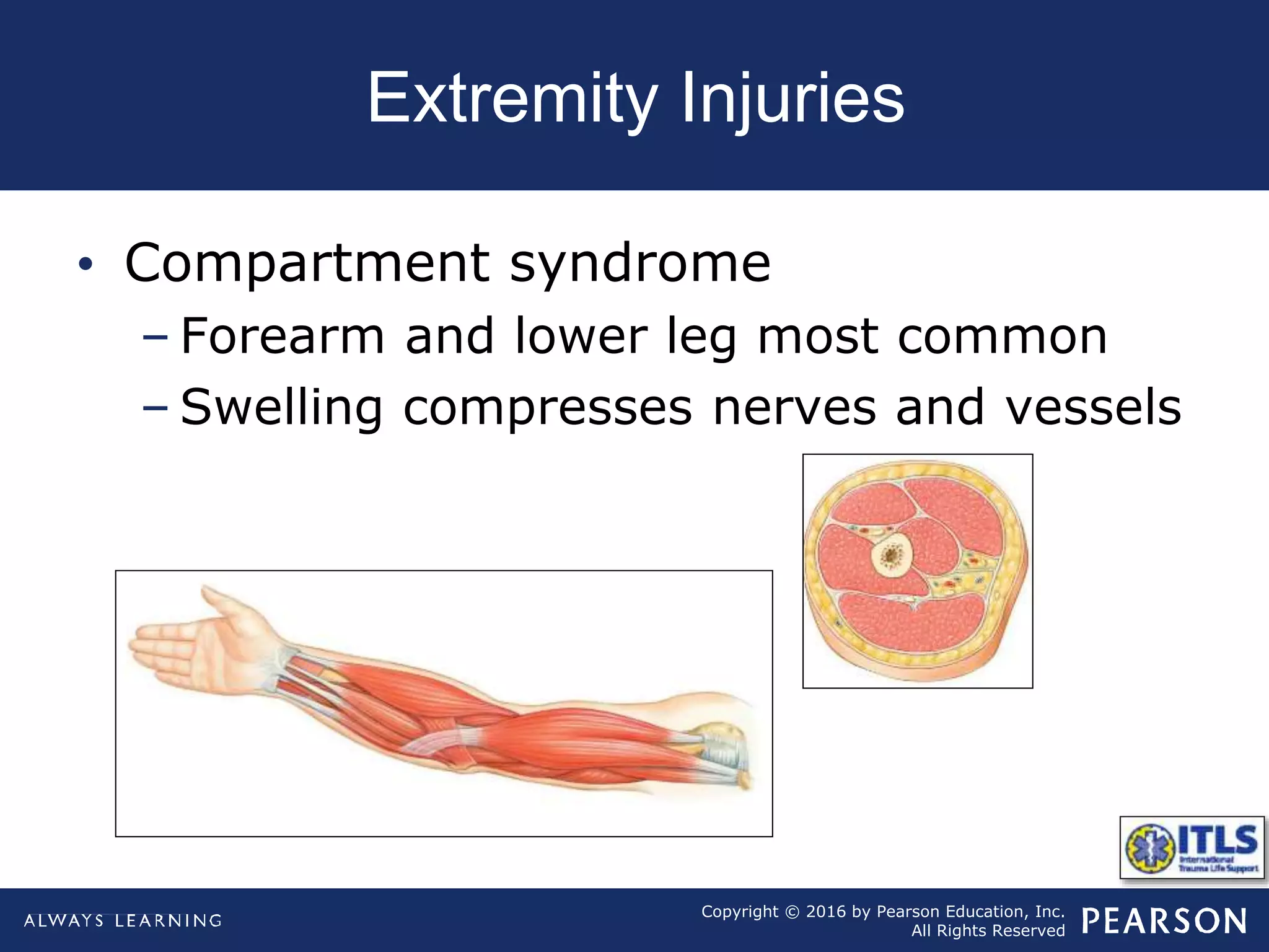 Chapter14 extremity trauma | PPT