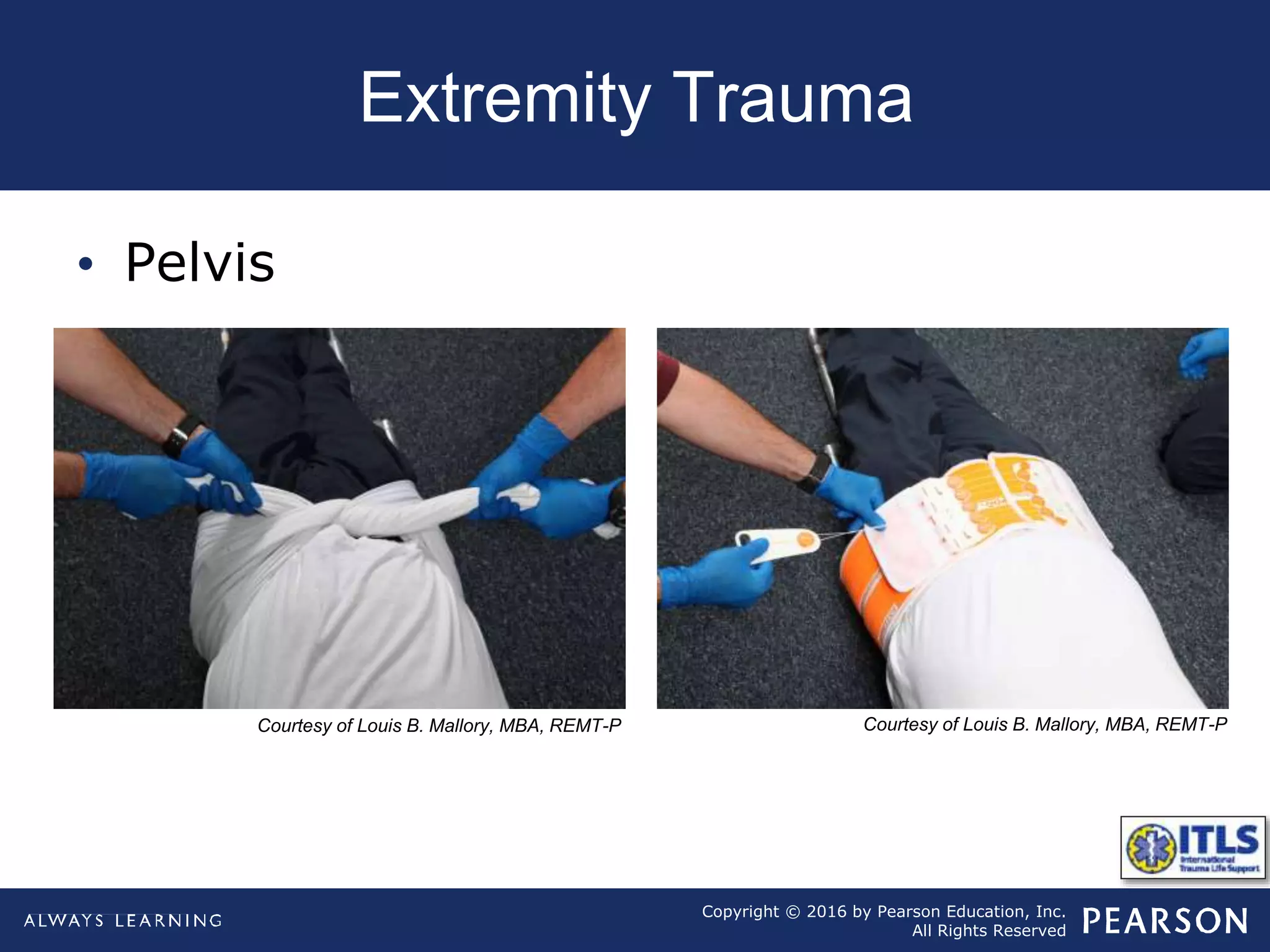 Chapter14 extremity trauma | PPT