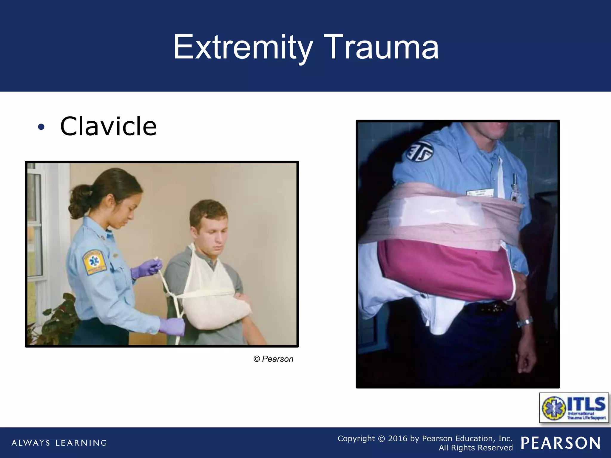 Chapter14 extremity trauma | PPT