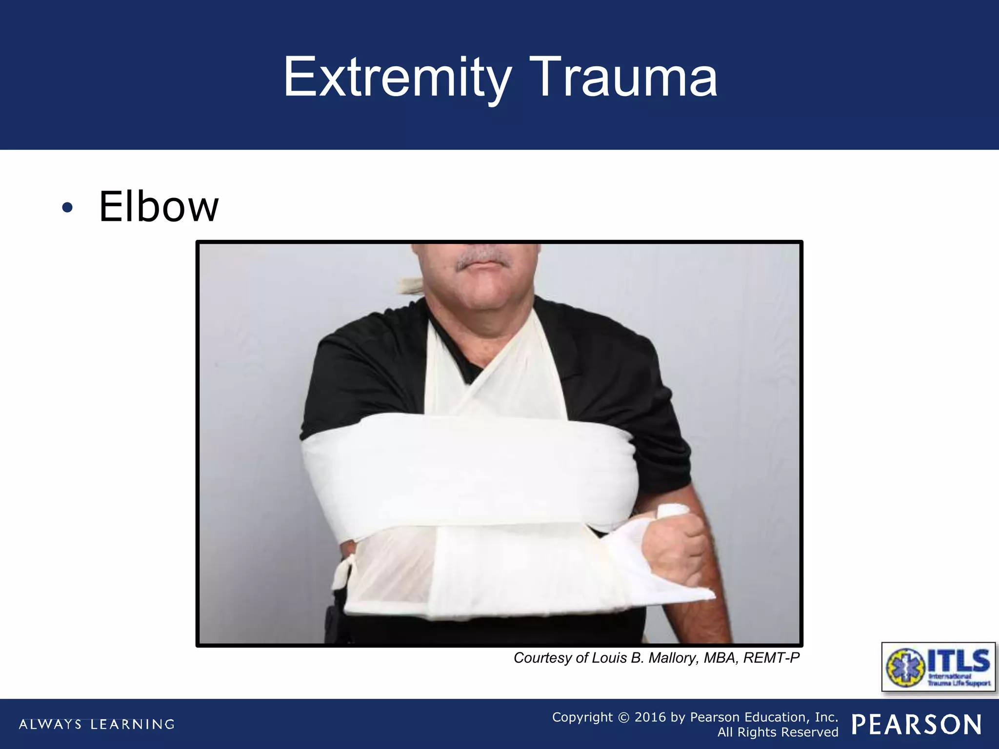Chapter14 extremity trauma | PPT