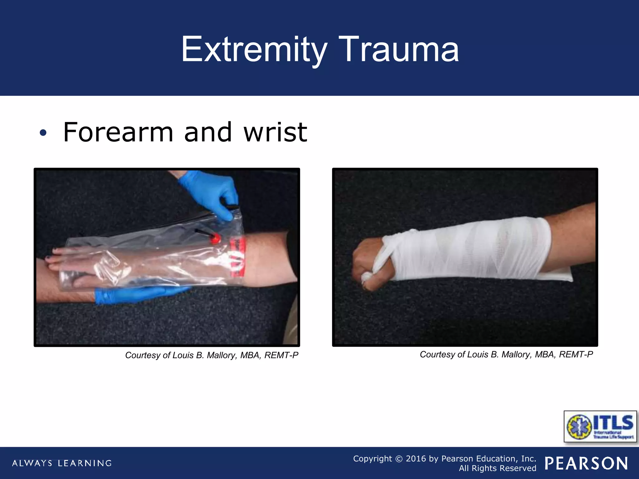 Chapter14 extremity trauma | PPT