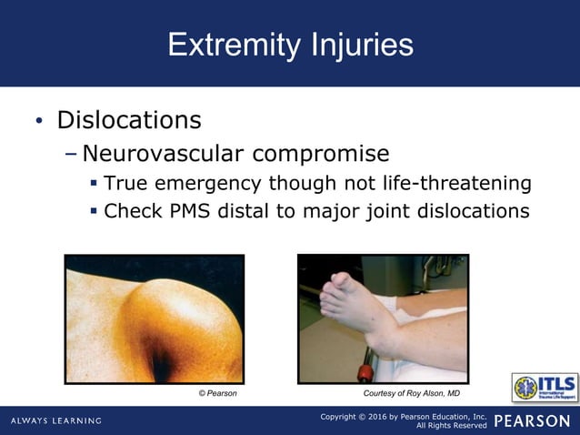 Chapter14 extremity trauma | PPT