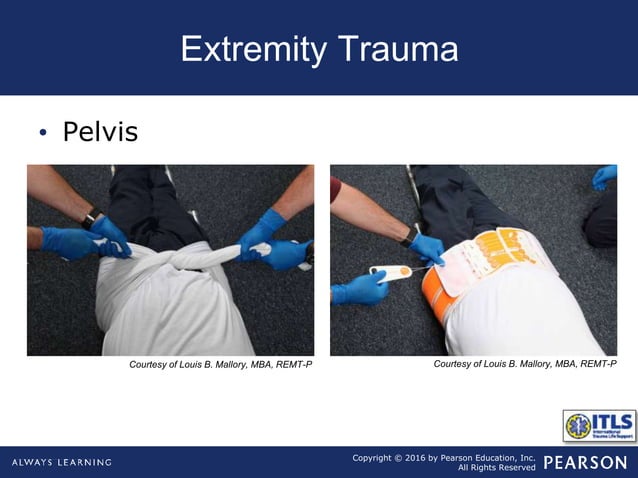 Chapter14 extremity trauma | PPT