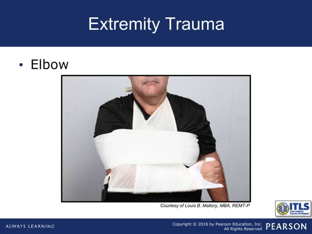 Chapter14 extremity trauma | PPT