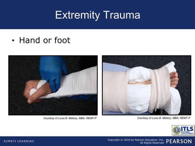 Chapter14 extremity trauma | PPT