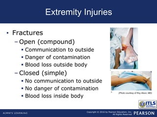Chapter14 extremity trauma | PPT