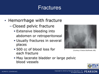 Chapter14 extremity trauma | PPT