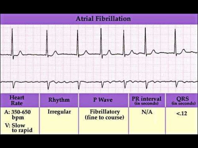 treatment of cardiac arrhythmias 2 | PPTX