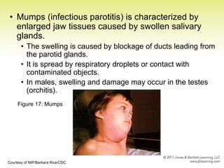 Viral Infections of the Respiratory Tract and Skin | PPT