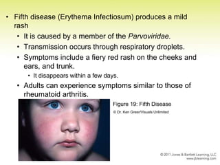 Viral Infections of the Respiratory Tract and Skin | PPT