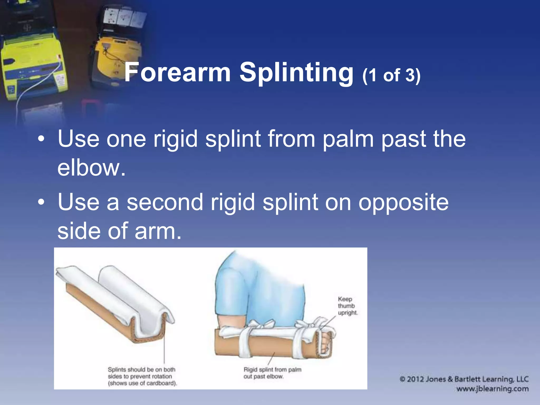 Chapter 16 Splinting Extremeties | PPTX