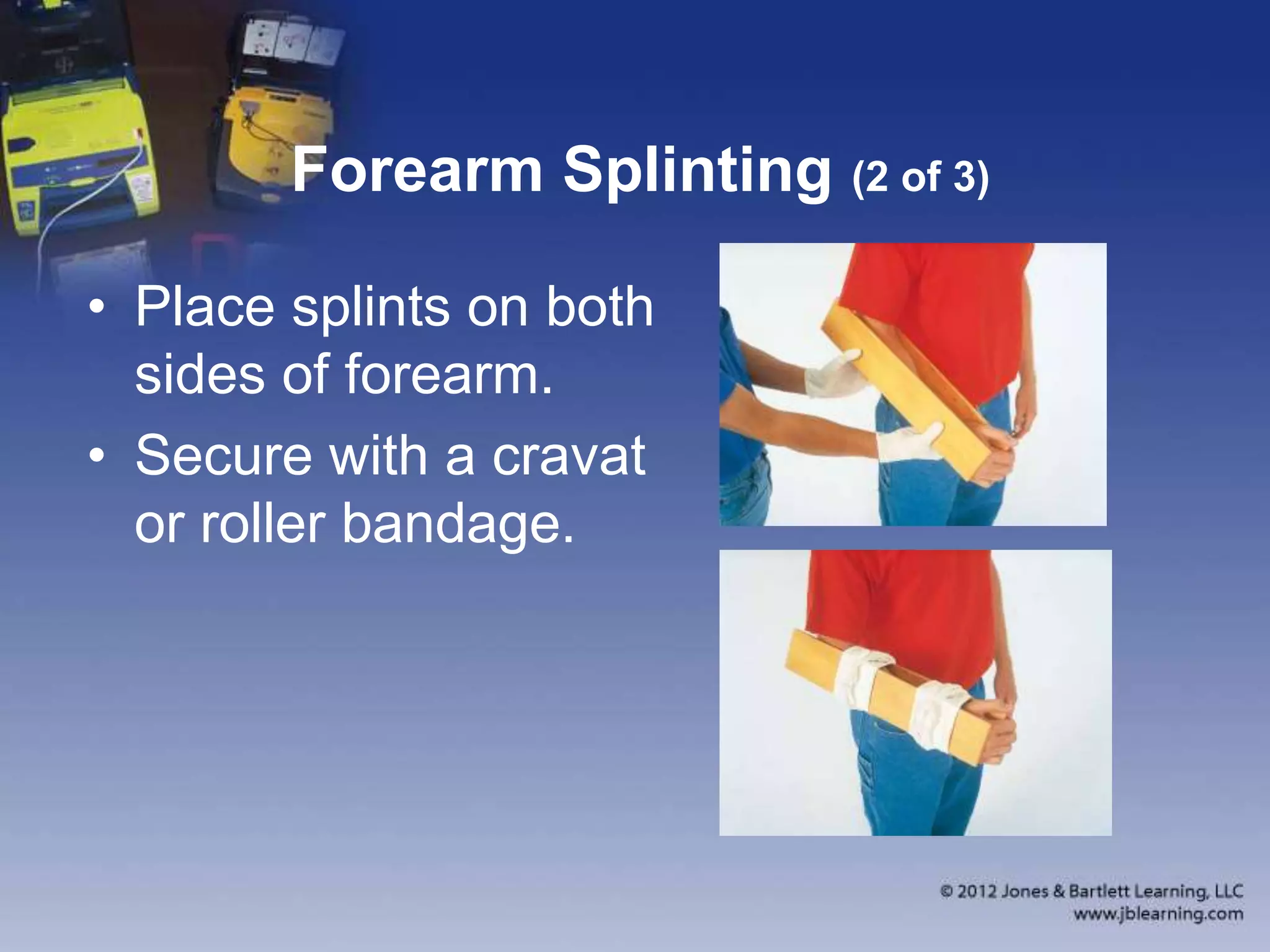 Chapter 16 Splinting Extremeties | PPTX