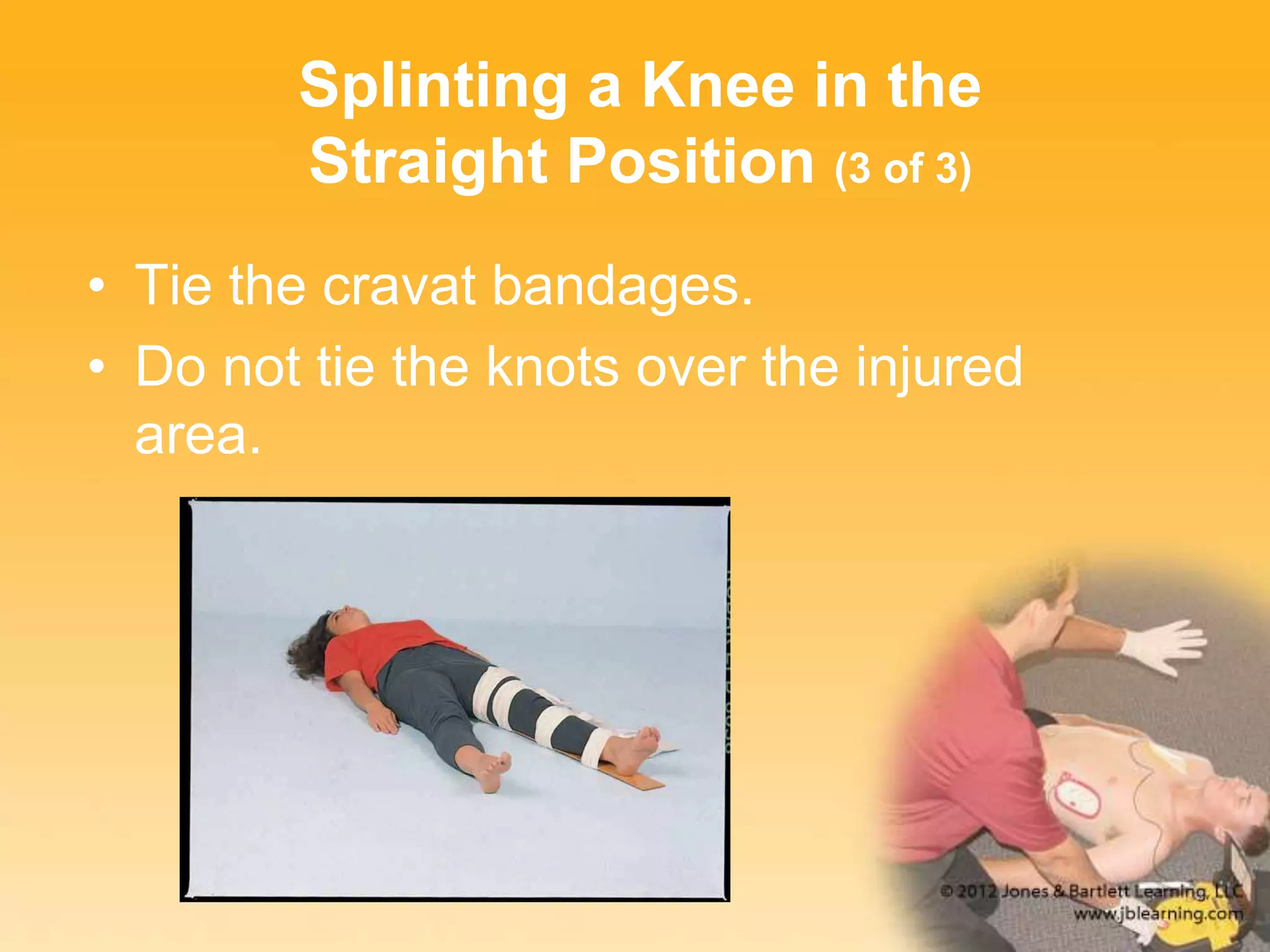 Chapter 16 Splinting Extremeties | PPTX