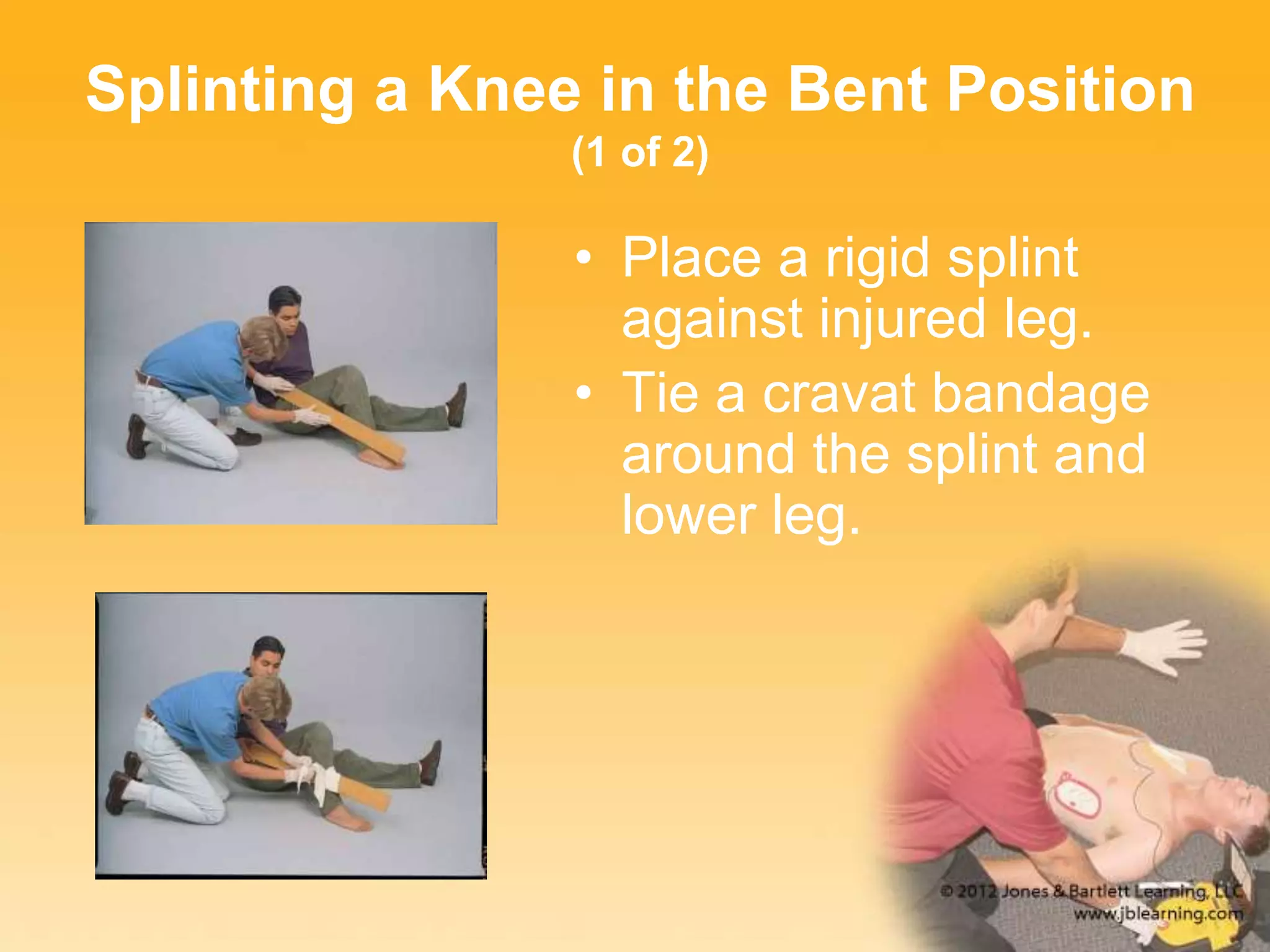 Chapter 16 Splinting Extremeties | PPTX