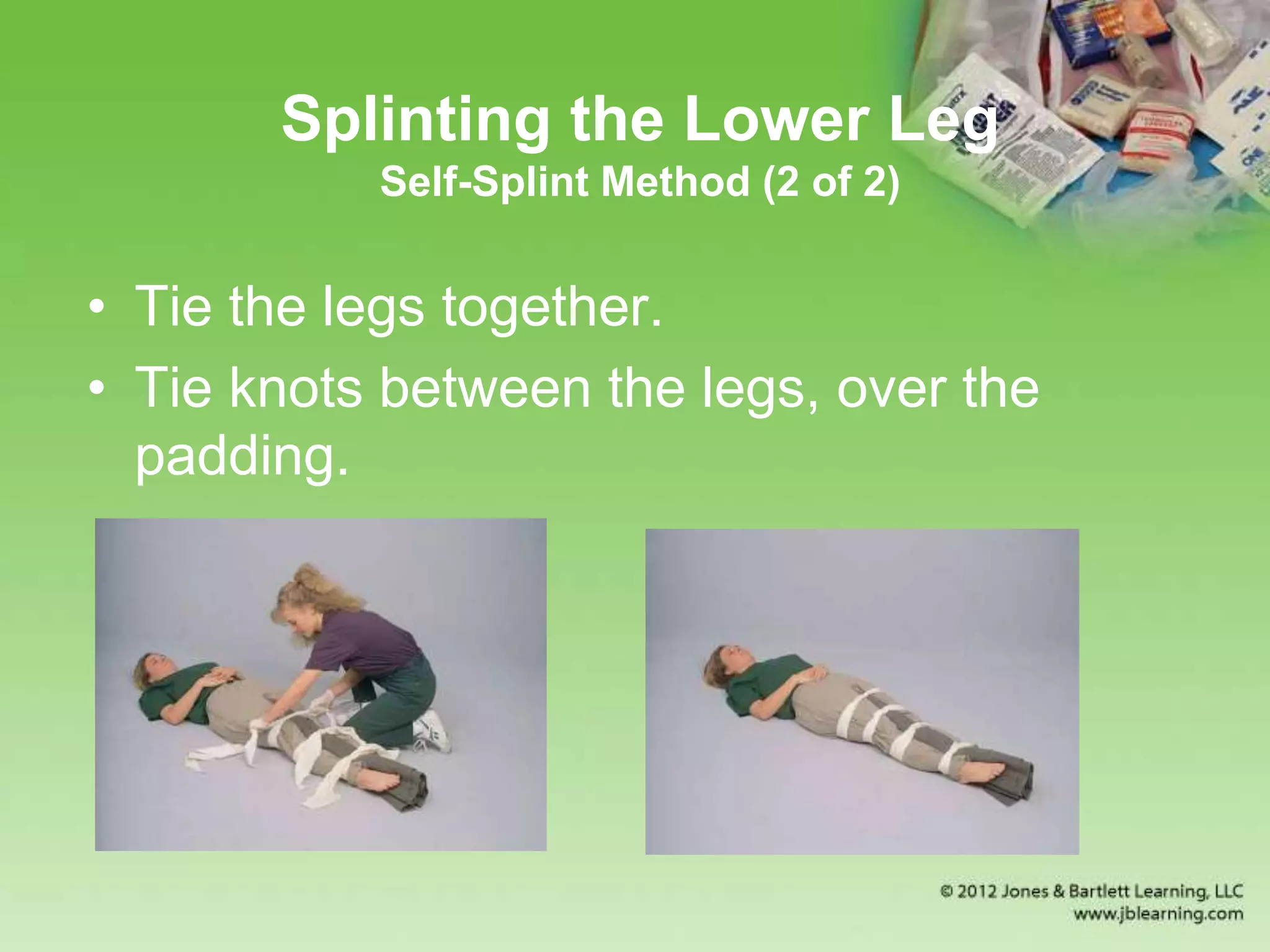 Chapter 16 Splinting Extremeties | PPTX