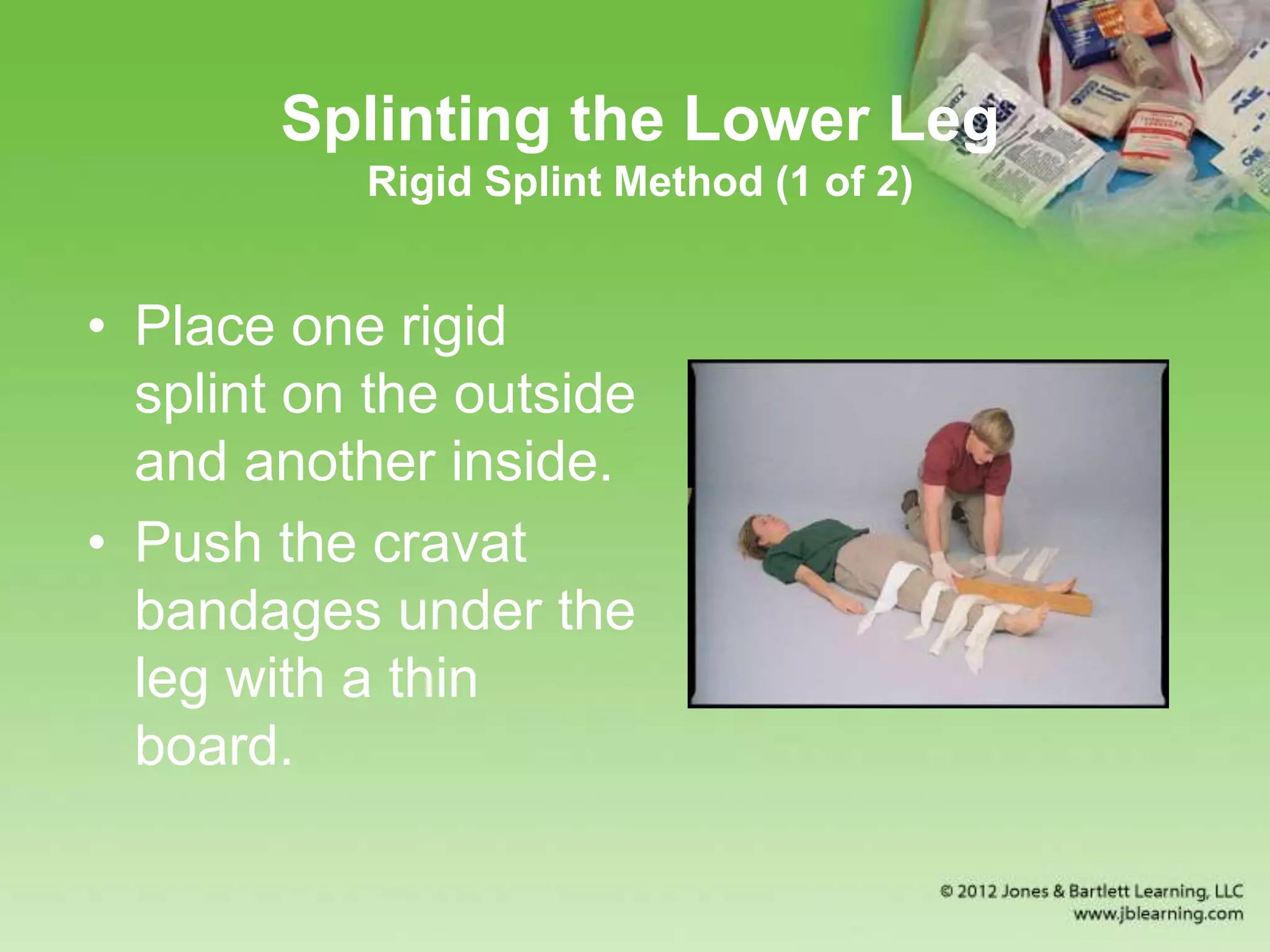Chapter 16 Splinting Extremeties | PPTX