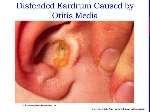Bulging Eardrum