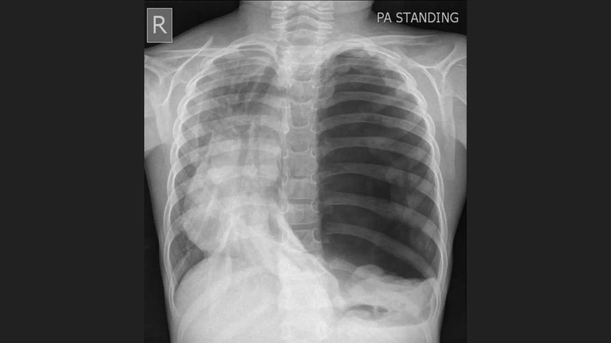 Chapter 17 _ Pleura, Chest Wall, Diaphragm, and Miscellaneous Chest ...