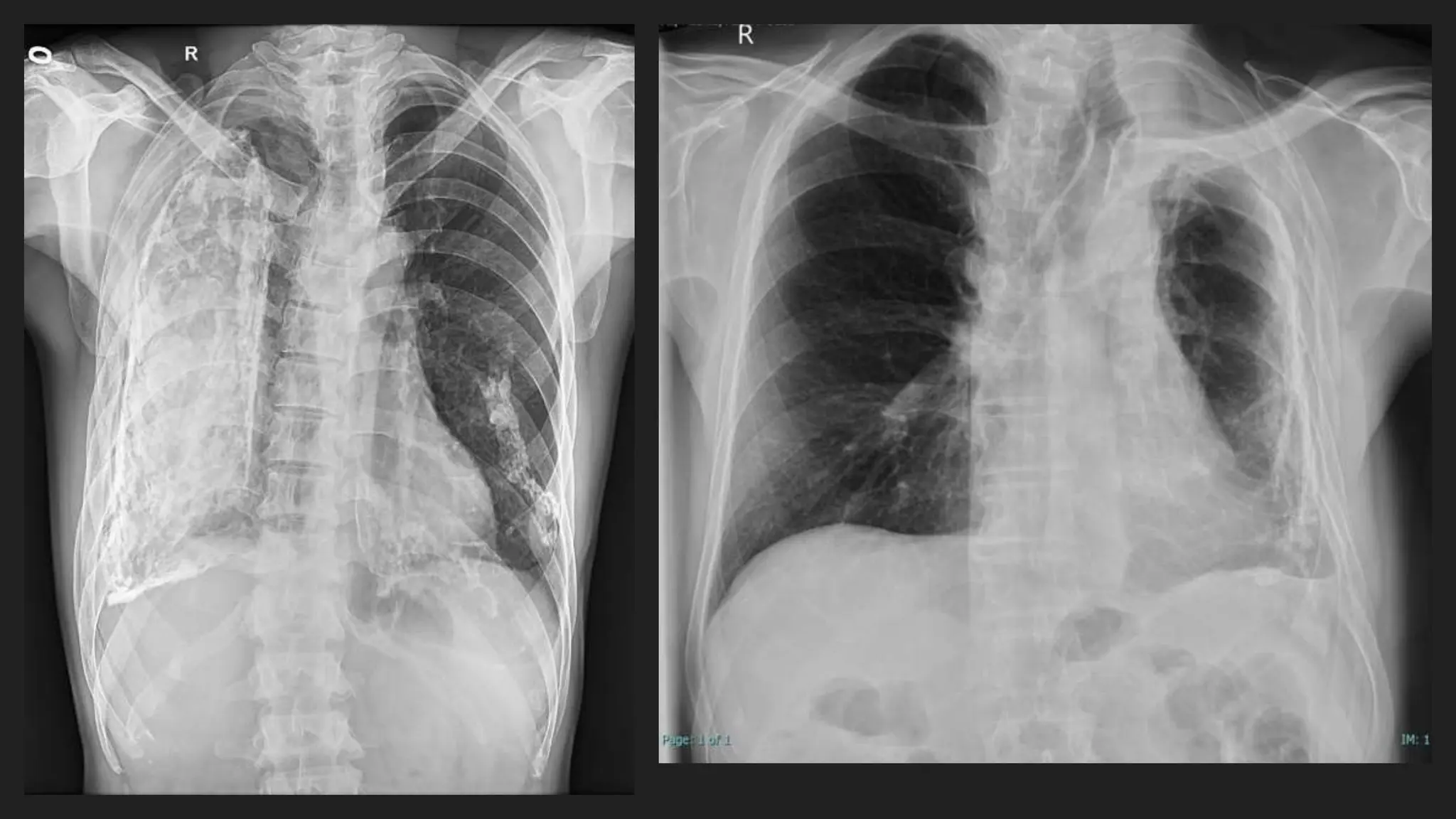 Chapter 17 _ Pleura, Chest Wall, Diaphragm, and Miscellaneous Chest ...