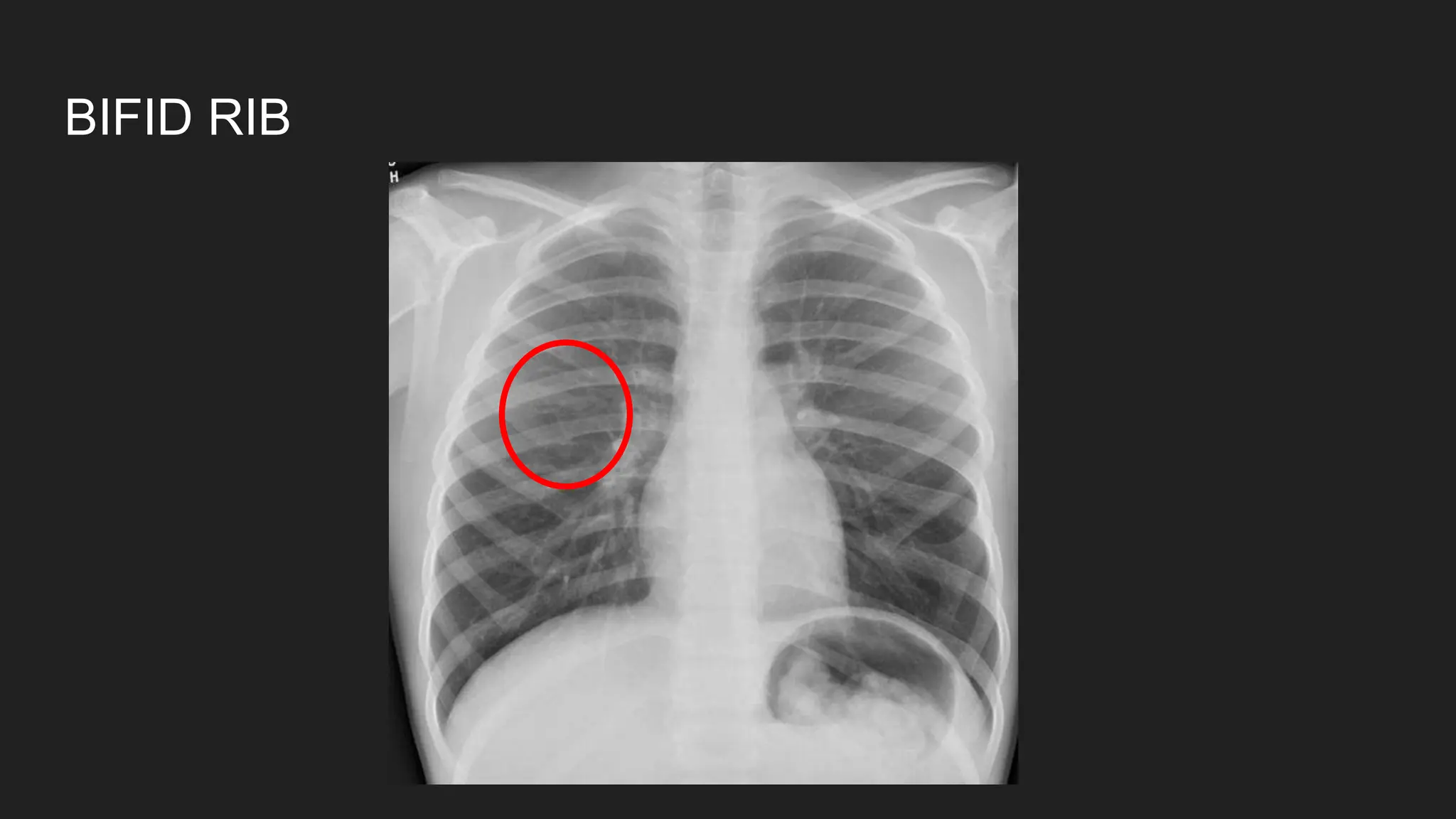 Chapter 17 _ Pleura, Chest Wall, Diaphragm, and Miscellaneous Chest ...