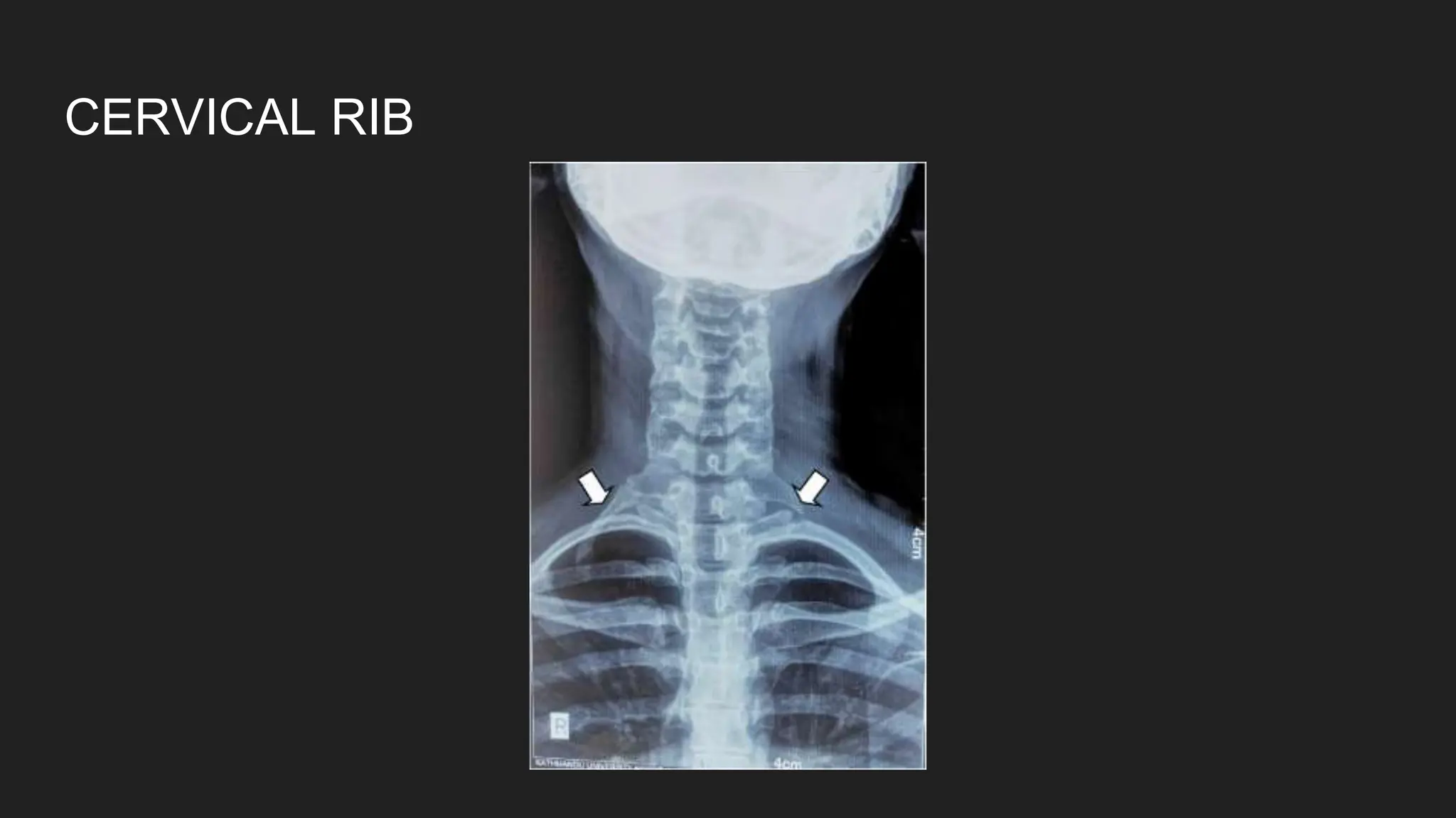 Chapter 17 _ Pleura, Chest Wall, Diaphragm, and Miscellaneous Chest ...