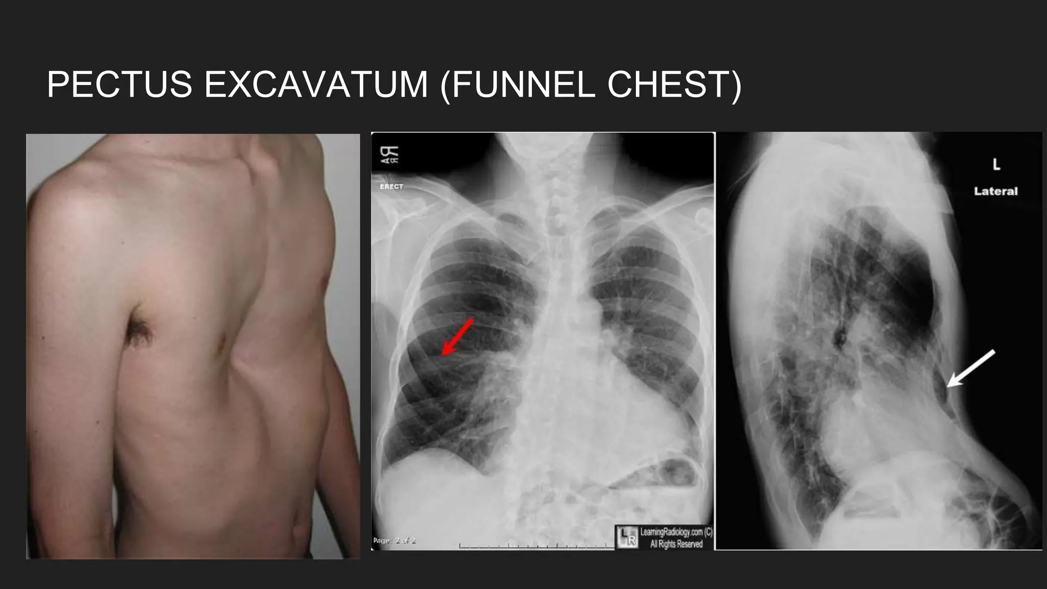 Chapter 17 _ Pleura, Chest Wall, Diaphragm, and Miscellaneous Chest ...