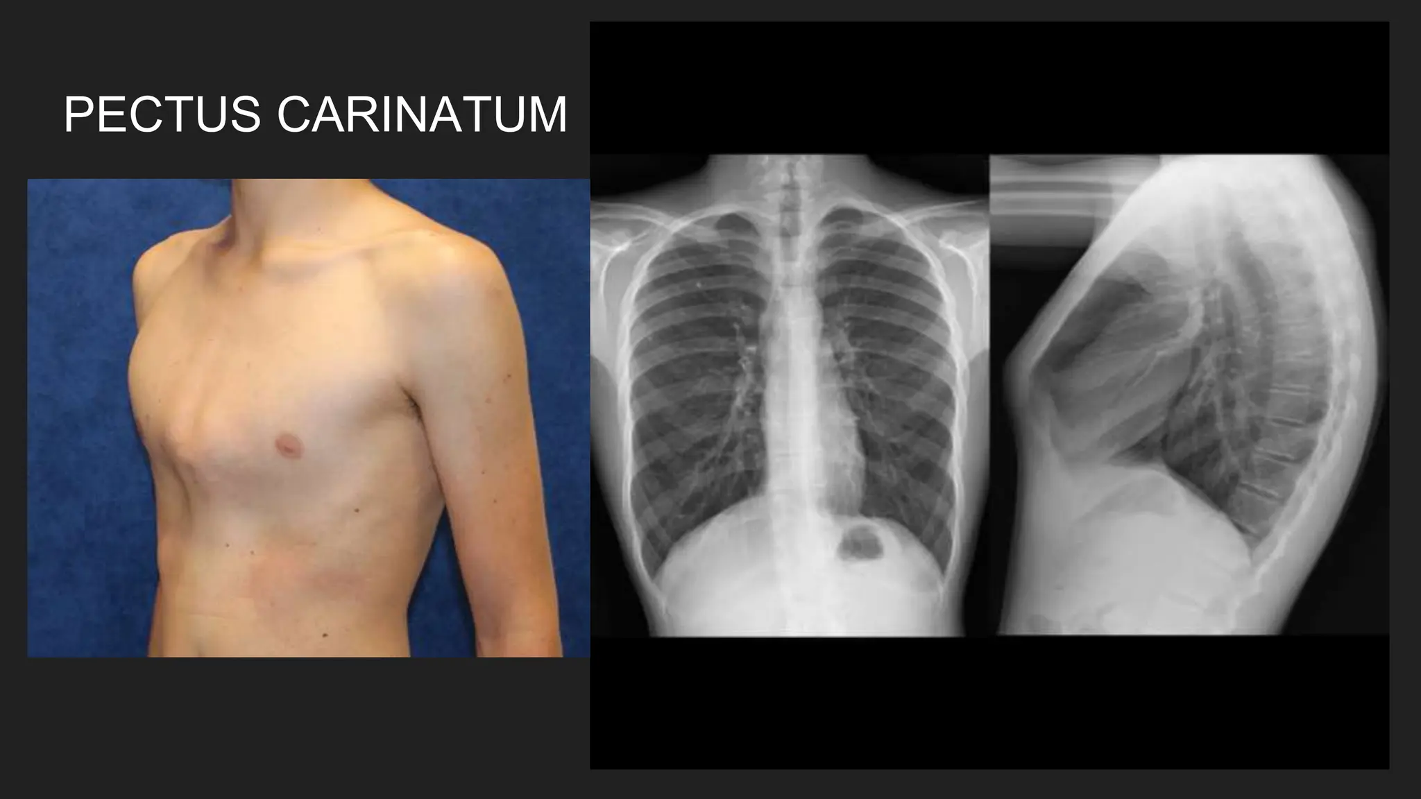 Chapter 17 _ Pleura, Chest Wall, Diaphragm, and Miscellaneous Chest ...