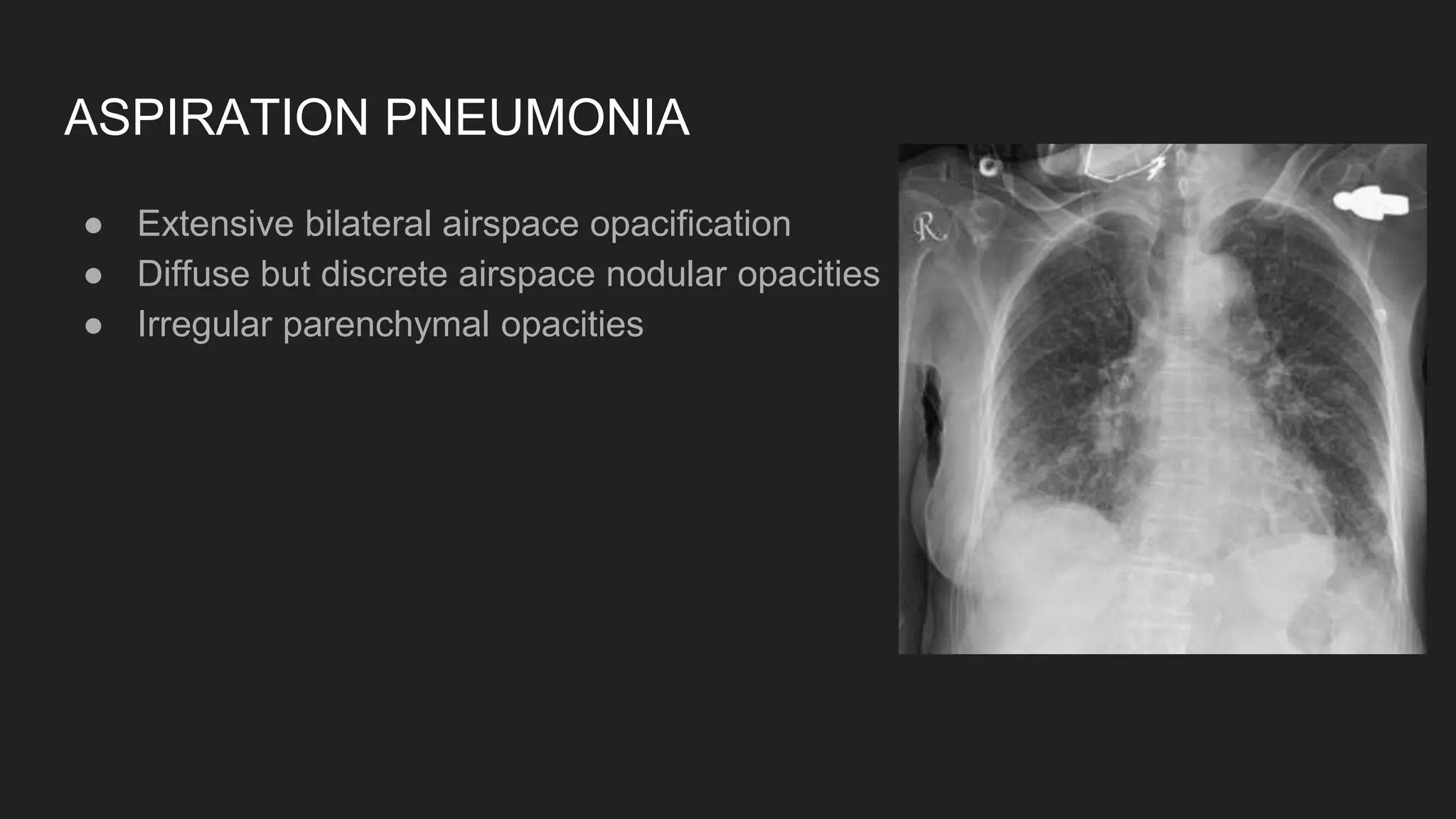 Chapter 17 _ Pleura, Chest Wall, Diaphragm, and Miscellaneous Chest ...