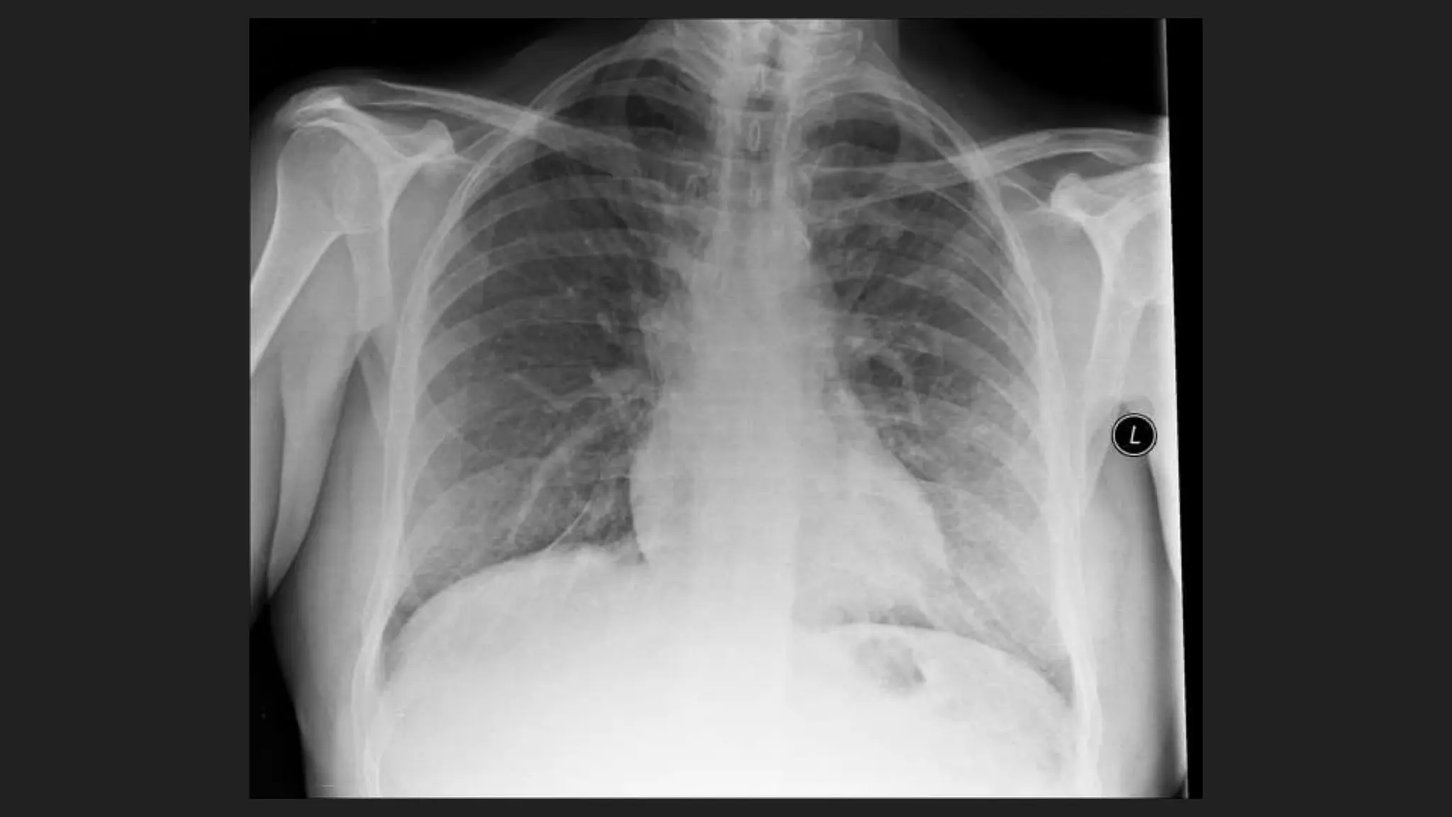 Chapter 17 _ Pleura, Chest Wall, Diaphragm, and Miscellaneous Chest ...