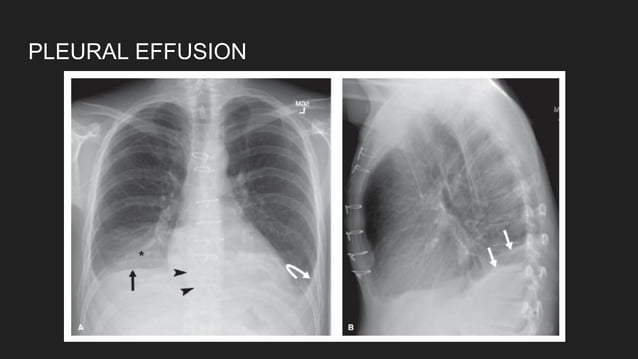 Chapter 17 _ Pleura, Chest Wall, Diaphragm, and Miscellaneous Chest ...