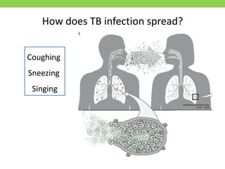 Chapter 1 understanding tb | PPTX | Lung and Respiratory Health ...