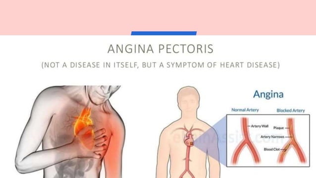 Angina pectoris and myocardial infraction.pptx