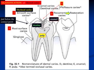 Dental caries and periodontal diseases.ppt