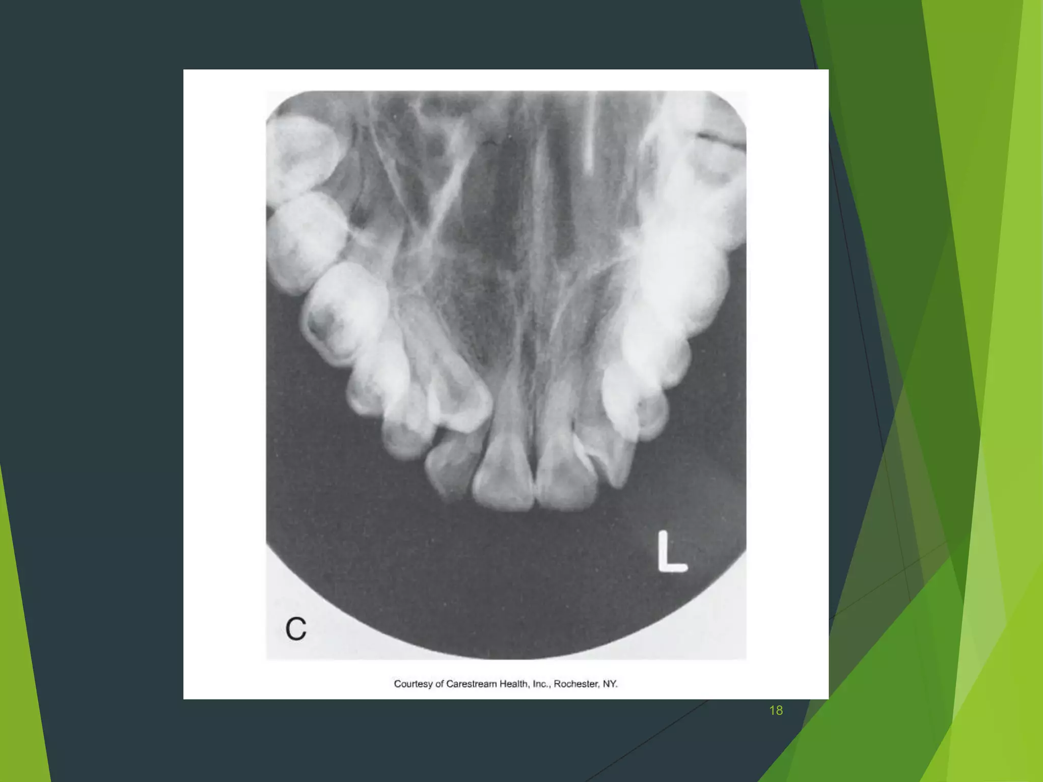 Chapter 21: Occlusal and Localization Technique | PPT